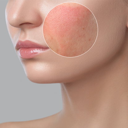ROSACEA - Dermatology Associates